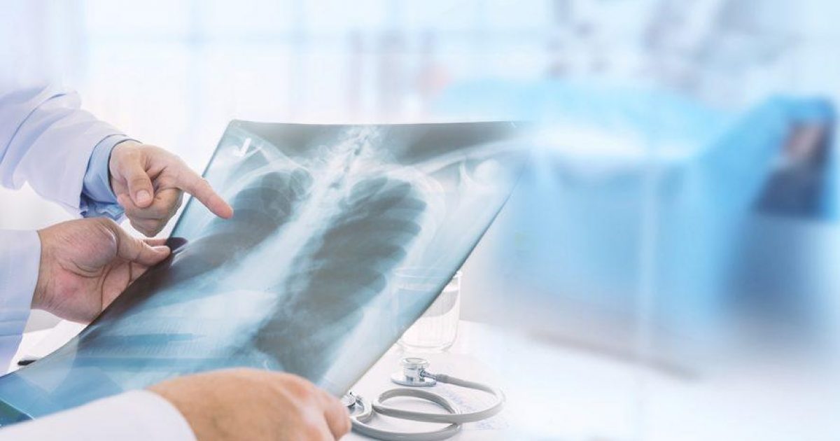 Oorzaken en symptomen van longkanker | Longkanker Nederland